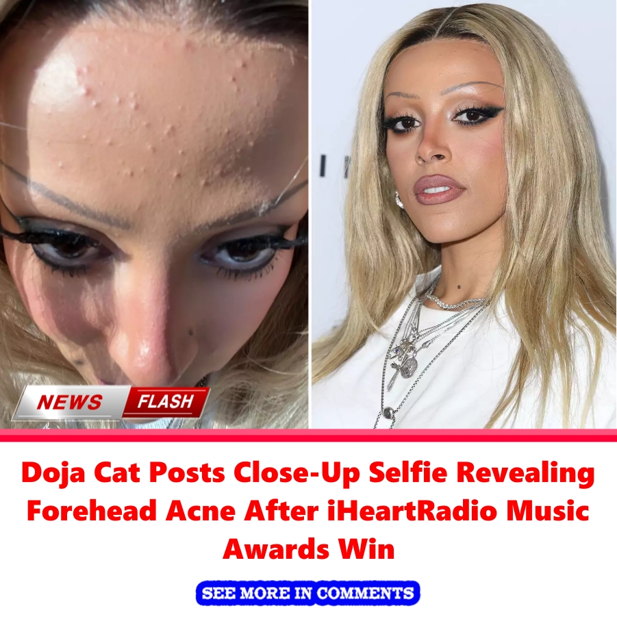 Doja Cat Posts Close-Up Selfie Revealing Forehead Acne After ...