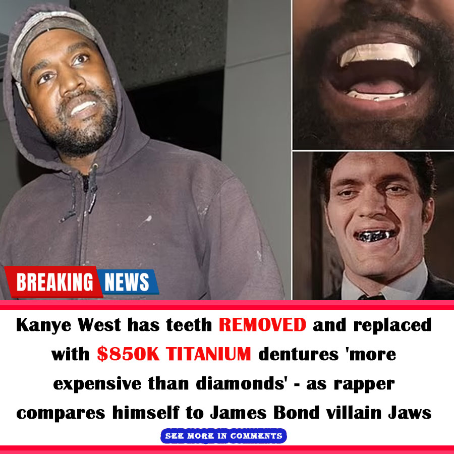 Kanye West has teeth REMOVED and replaced with $850K TITANIUM dentures ...