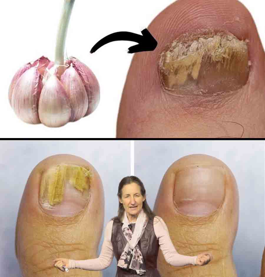 How Garlic Helps Eliminate Fungal Foot Infections Naturally - News