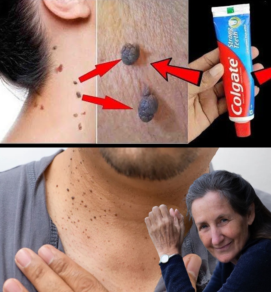 How to Get Rid of Plantar Warts and Skin Tags Overnight: Simple Home ...