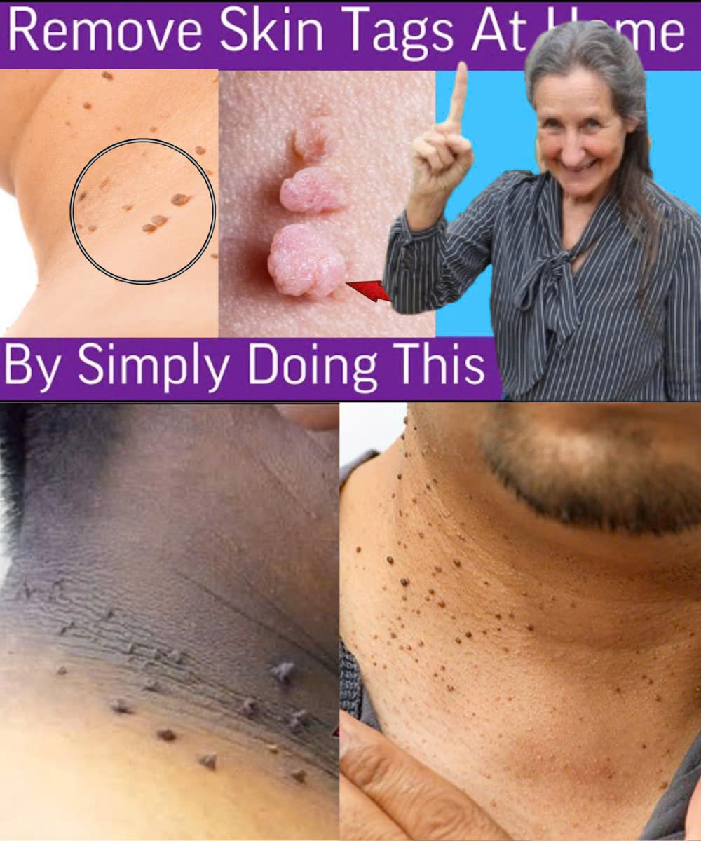 Plantar Warts and Skin Tags Disappear Overnight with this recipe - News